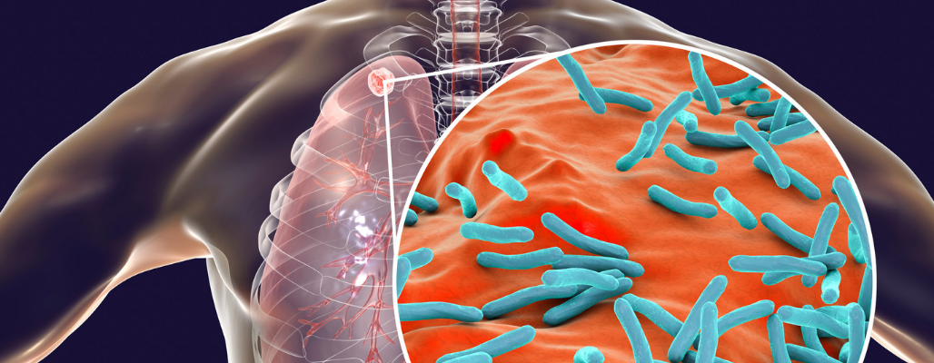 ¿Sabes qué es la tuberculosis?